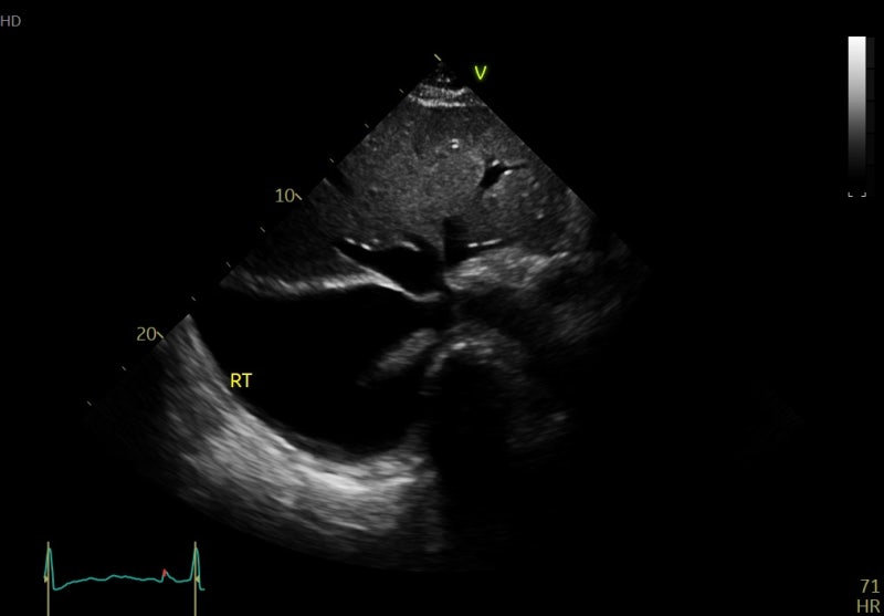 Constrictive pericarditis(교착성 심내막염) : 네이버 블로그