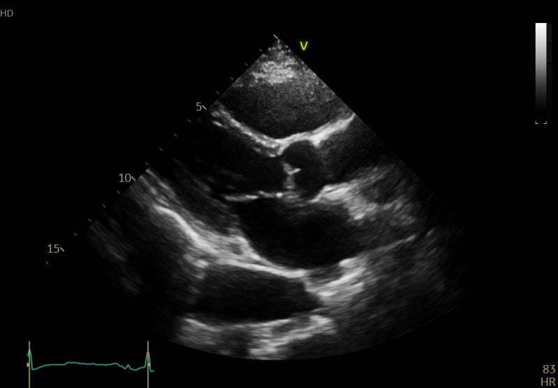 Constrictive pericarditis(교착성 심내막염) : 네이버 블로그