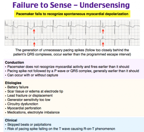 Temporary Pacemaker(TPM), 임시심박동기 : 네이버 블로그