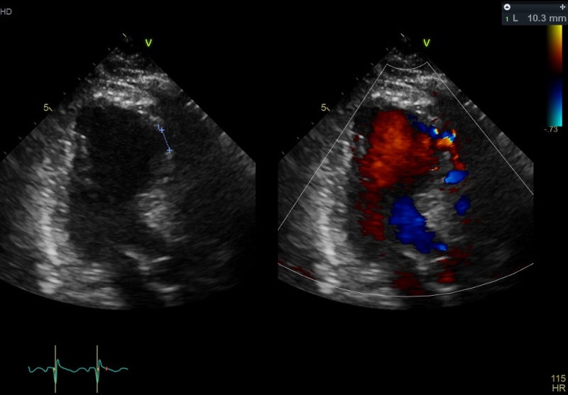 Post MI VSD (심근경색후 발생한 심실중격파열) : 네이버 블로그