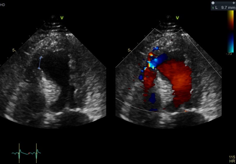 Post MI VSD (심근경색후 발생한 심실중격파열) : 네이버 블로그