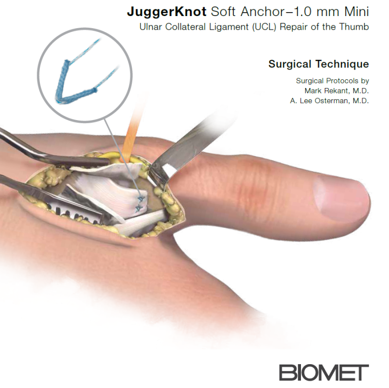 Hand-thumb MCP UCL repair 중수지관절 척측인대 봉합술 : 네이버 블로그