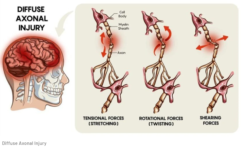 Diffuse axonal injury (DAI, 미만성 축삭 손상) : 네이버 블로그