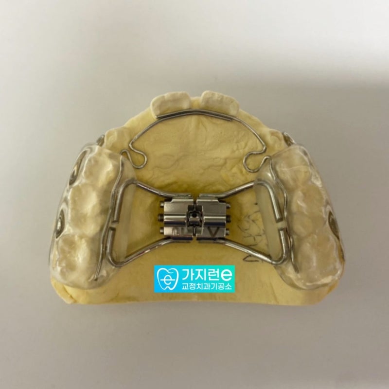 bonded rpe (feat. 전치부 guide wire) 입니다. : 네이버 블로그