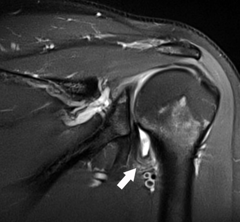 Frozen shoulder, adhesive capsulitis 진단 관련 내용 : 정상 어깨의 range of motion ...