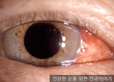 눈에 피가 났어요 - 결막하 출혈 원인 치료 : 네이버 블로그