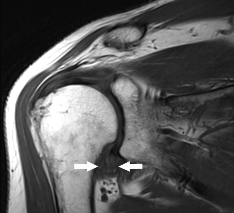 Frozen shoulder, adhesive capsulitis 진단 관련 내용 : 정상 어깨의 range of motion ...
