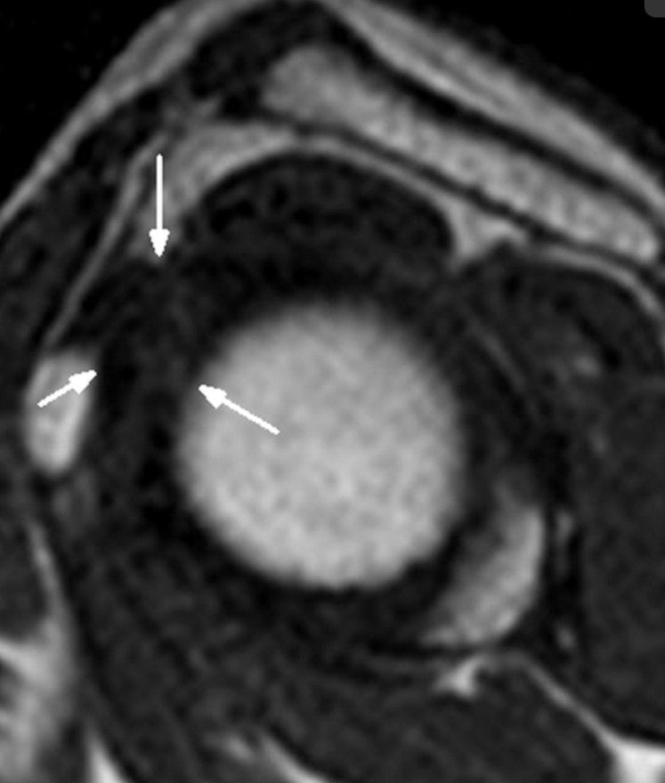 Frozen shoulder, adhesive capsulitis 진단 관련 내용 : 정상 어깨의 range of motion ...