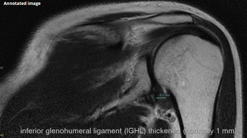 Frozen shoulder, adhesive capsulitis 진단 관련 내용 : 정상 어깨의 range of motion ...