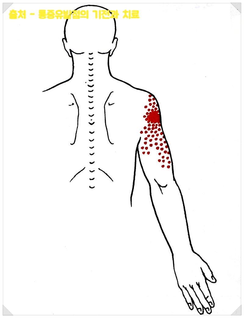 어깨통증 원인 - 극하근(Infraspinatus)과 소원근(Teres minor)의 연관통(Referred pain)과 ...