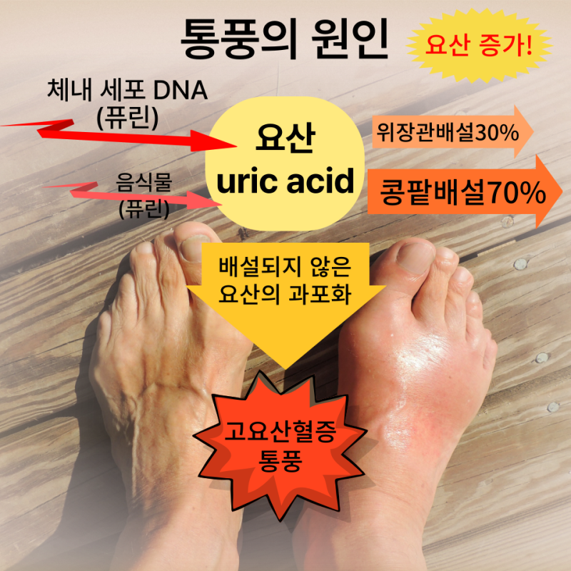 통풍 고요산혈증 8 요산수치 9 음식관리도 하고 병원 치료와 정기검사도 병행해야하는 이유는 원인을 생각해보면 네이버 블로그