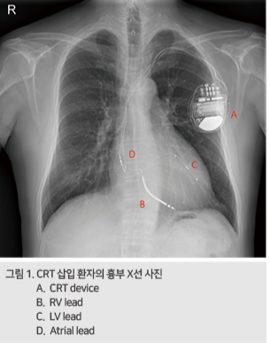 CRT : Cardiac Resynchronization therapy 심장 재동기화 치료 - 원리, 목적, 적응증 : 네이버 블로그