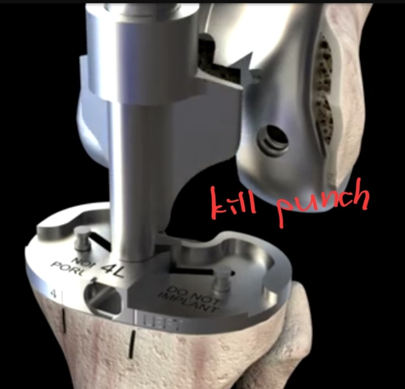 수술실 정형외과 스크럽-TKR ( CR - Cruciate ) Procedure 2 TKRA 프로시져 : 네이버 블로그