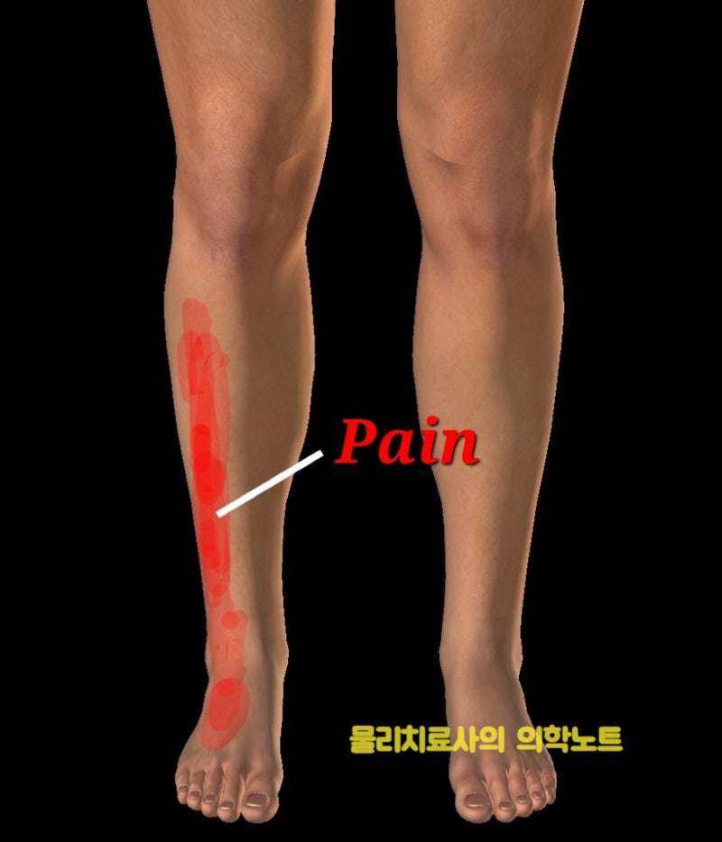 정강이 통증shin Splint 원인 전경골근앞정강근 Tibialis Anterior 긴장 네이버 블로그