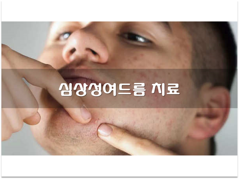 크레오신티 크레오신 외용액 여드름 치료제 항생제 처방 성분 효능 효과 사용법 부작용 주의사항 블랙헤드 좁쌀 네이버 블로그