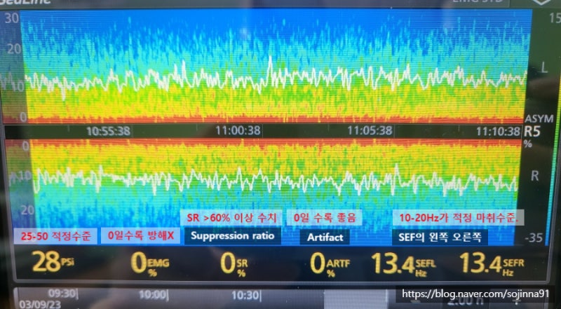 마취 심도 모니터링 : Sedline(Masimo)에 관하여(SEF, suppression ratio, DSA, EMG ...