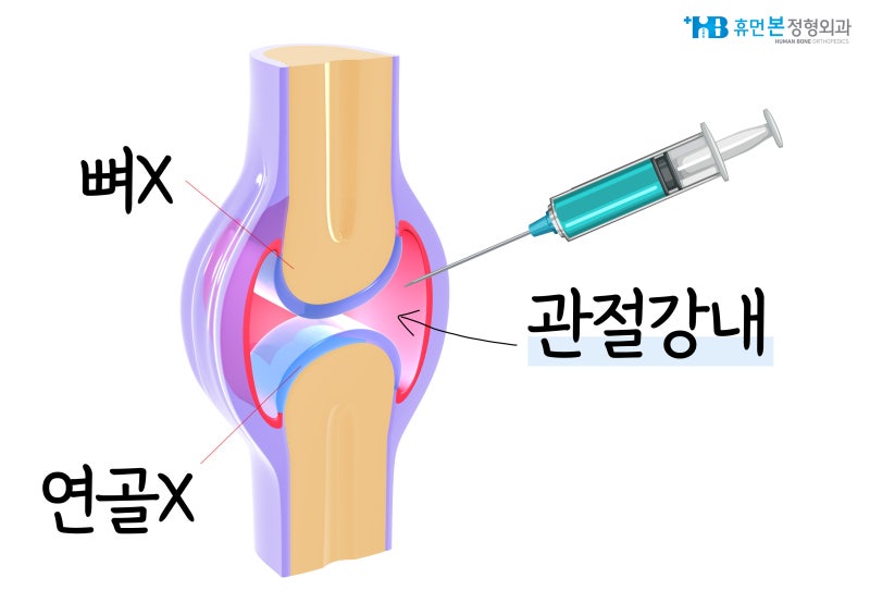 무릎 연골주사 효과부작용 횟수간격3회 효과 가격 실비의료보험 네이버 블로그