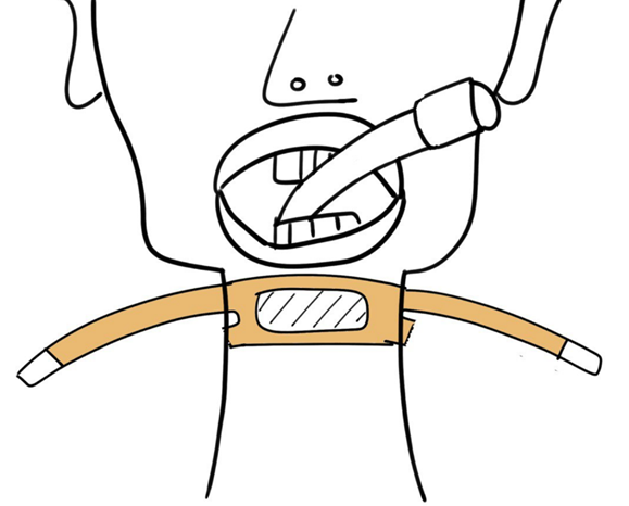 ET tube 고정하는 법(Tape, Anchor fast(ET tube holder)) : 네이버 블로그
