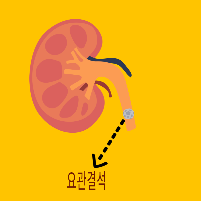 요로결석 신장결석 요관결석 방광결석 요도결석은 무엇이 다른가 요로결석 용어 총정리 네이버 블로그