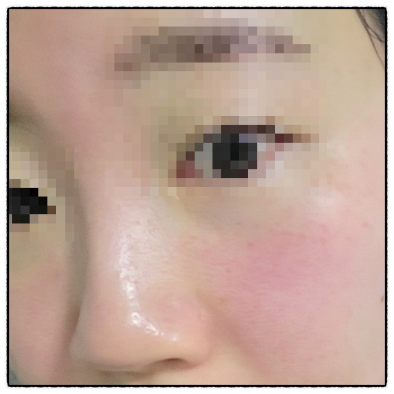 기미 잡티에 피코토닝 후기 효과와 부작용에 대해서기미란 네이버 블로그