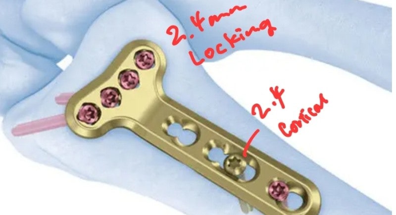 수술실 정형외과 스크럽- Wrist ORIF 보강 plate -hand ORIF : 네이버 블로그