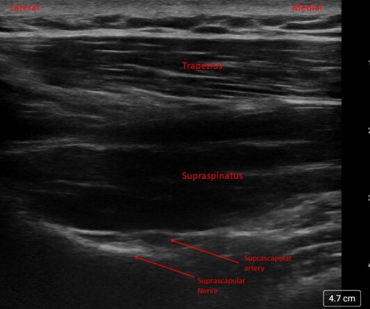 Suprascapular nerve block(어깨 신경주사)에 대하여 : 주행경로, 초음파 하 신경차단술. : 네이버 블로그