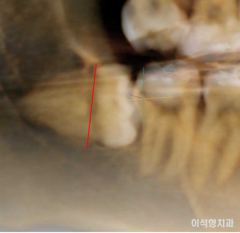 완전 매복 사랑니 발치 과정과 발치 후 감염 예방 네이버 블로그
