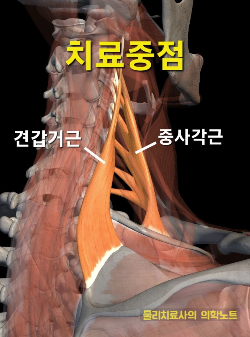 견갑골 내측 통증 원인 사각근scalene 긴장 견갑배신경 포착 증후군dorsal Scapular Nerve