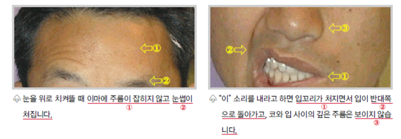 안면마비구안와사안면신경마비얼굴마비와사풍 정의원인전조증상 뇌졸중과의 차이점 네이버 블로그