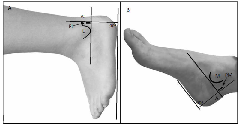 Ankle- A/S posterior synovectomy / A/S Os trigonum excision : 네이버 블로그