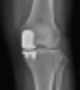 무릎 인공관절 '부분 치환술' (Unilateral Knee Arthroplasty, UKA) 는 언제 하나요? - 50대 ...