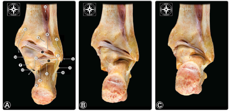 Ankle- A/S posterior synovectomy / A/S Os trigonum excision : 네이버 블로그