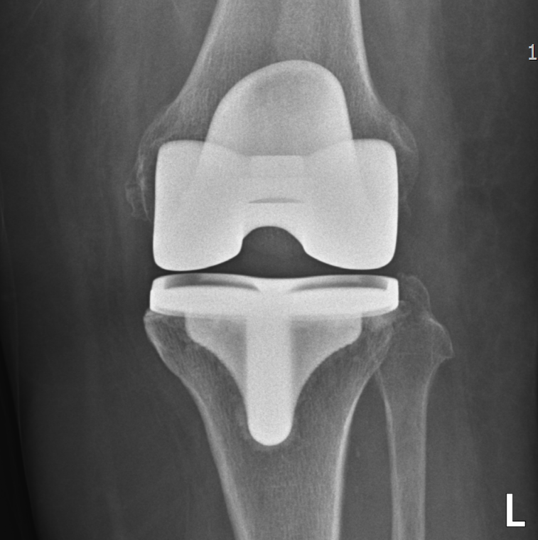 무릎 인공관절 '부분 치환술' (Unilateral Knee Arthroplasty, UKA) 는 언제 하나요? - 50대 ...