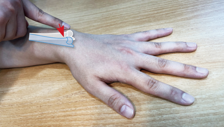 [응급진료매뉴얼: 근골격편] 삼각 섬유연골 복합체 손상(Triangular fibrocartilage complex tear ...