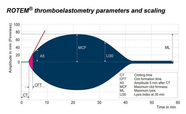 회전 혈전탄성측정법(ROTEM), 응고병증 지혈장애를 조기에 분석하는 유용한 검사법 : 네이버 블로그