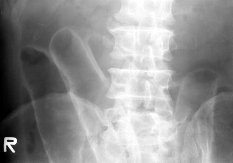 [복부] 복부 일반촬영 판독법 2 : 네이버 블로그