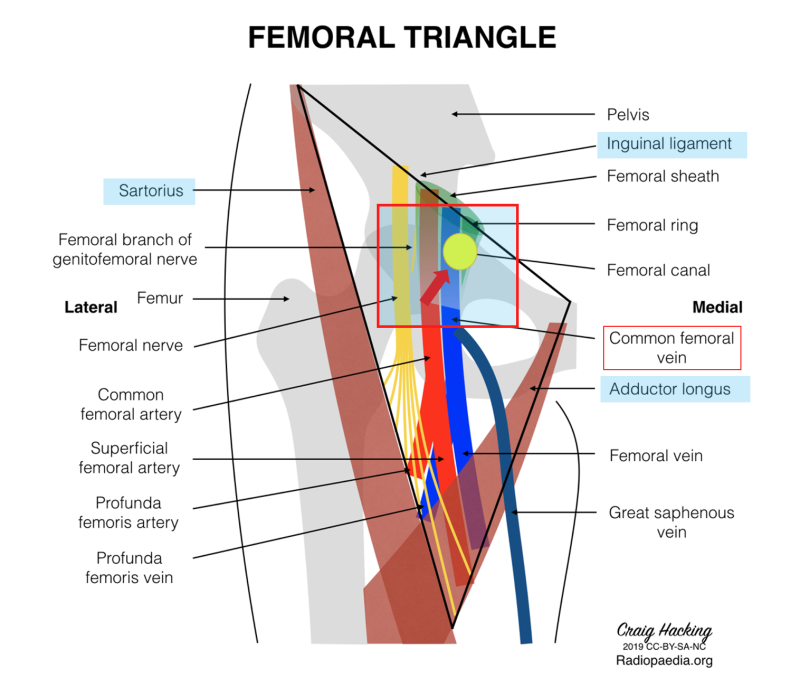 Femoral vein C-line insertion - '응급상황'에서 blind approach에 대한 정리 : 네이버 블로그