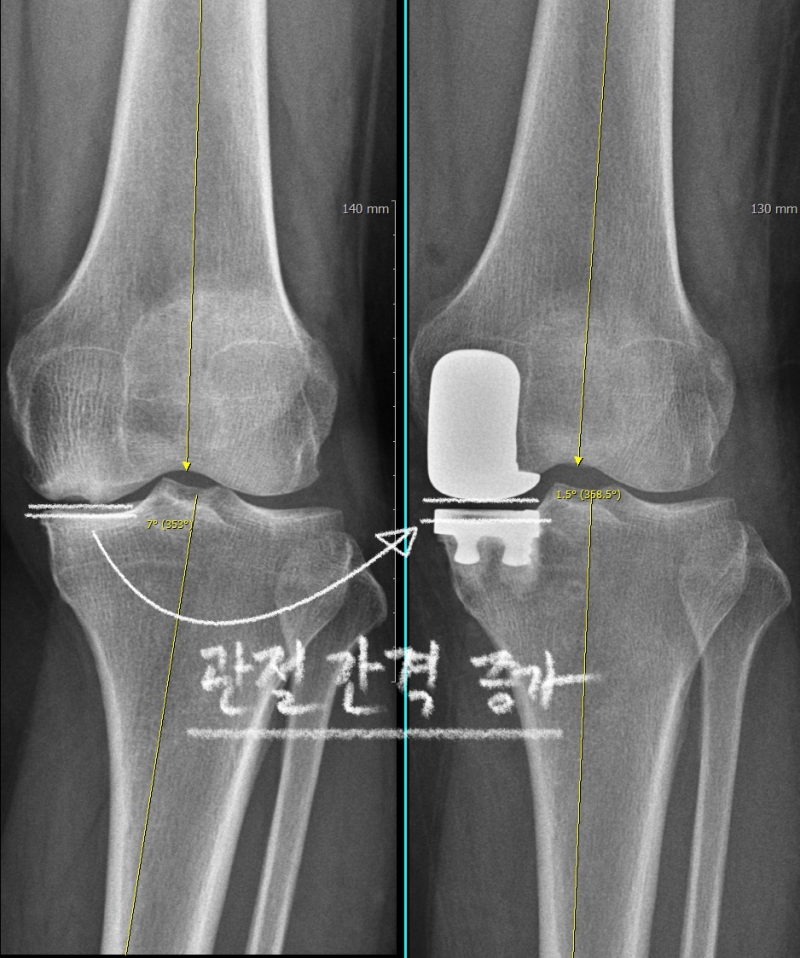무릎 인공관절 '부분 치환술' (Unilateral Knee Arthroplasty, UKA) 는 언제 하나요? - 50대 ...