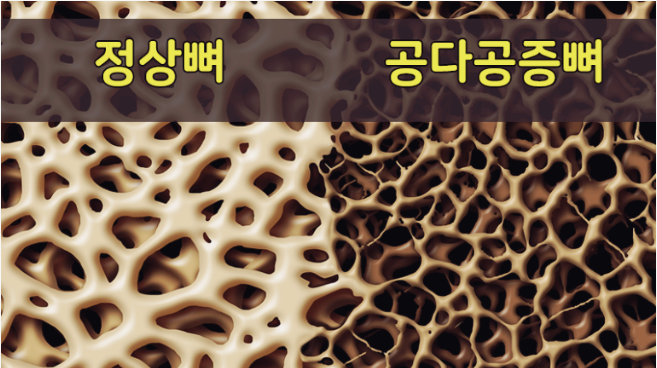 골다공증 주사 부작용 이렇게 심각했나요 프롤리아에 대하여 미리 알아보기 네이버 블로그