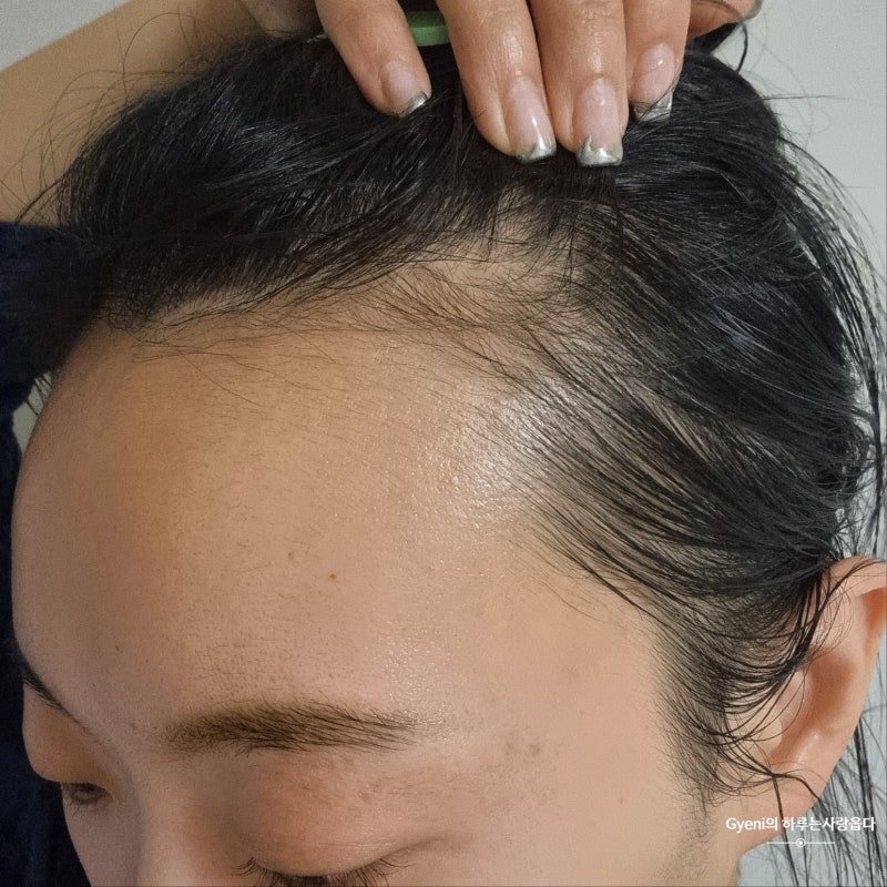 바이브랩vivelab 두피앰플 두달 사용 후기내돈내산비포애프터 네이버 블로그