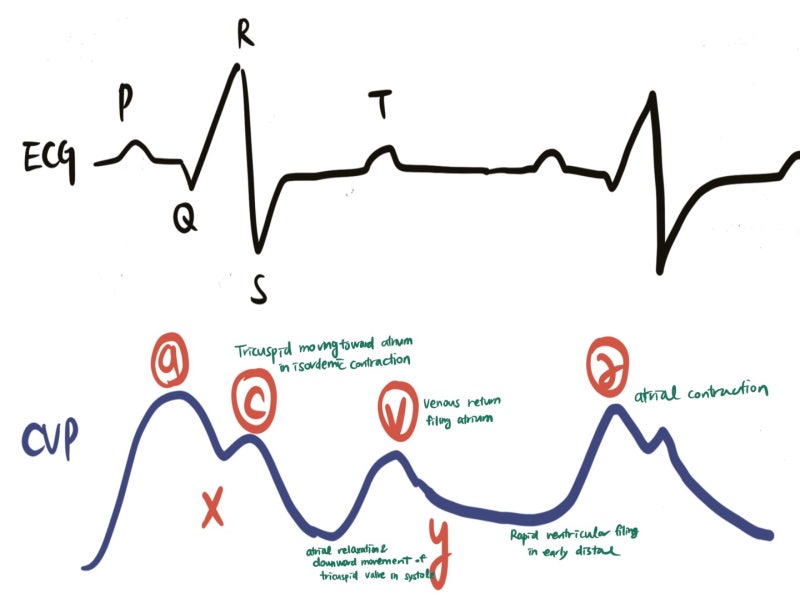 CVP 측정방법 & 정상수치 : 네이버 블로그