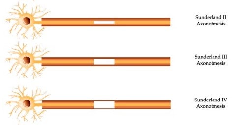 하치조신경마비 (inferior alveolar nerve numbness) 분류, 증상, 원인, 치료 - 1. 하치조신경마비 ...