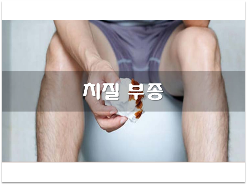 베노론 베노론캅셀 디오스민diosmin 하지정맥류 치질 부종 성분 효능 효과 복용법 부작용 주의사항 캡슐 네이버 블로그