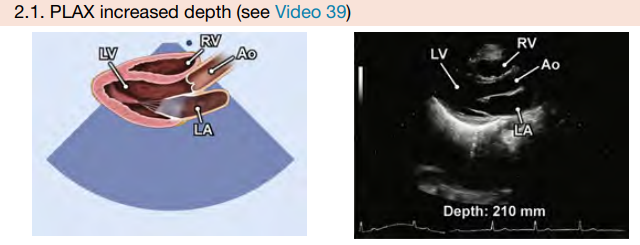 심장초음파(TTE) 2D 영상_PLAX, PSAX : 네이버 블로그