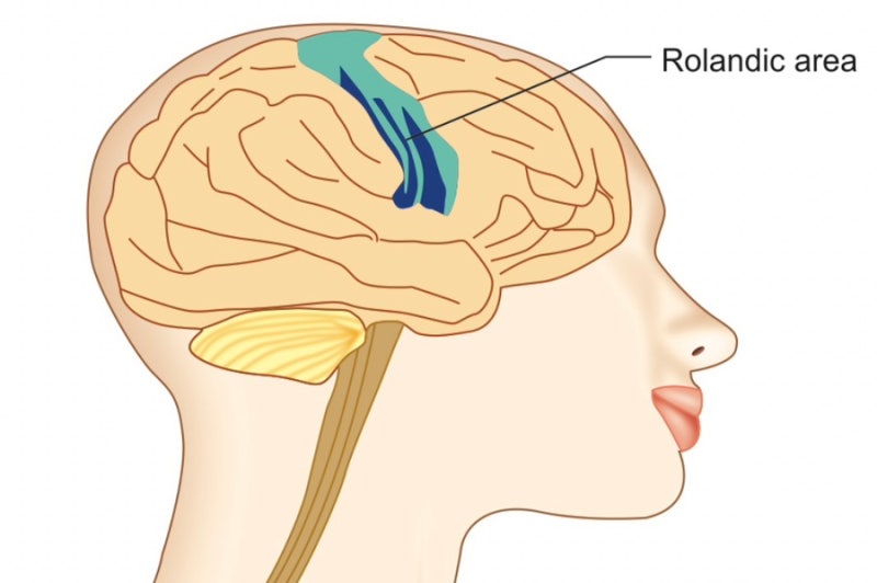 #1.Benign Rolandic Epilepsy(양성 롤란딕)-소아뇌전증 : 네이버 블로그