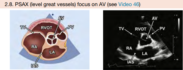 심장초음파(TTE) 2D 영상_PLAX, PSAX : 네이버 블로그