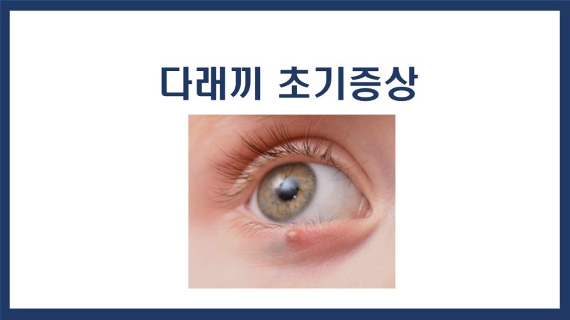 눈 다래끼 속다래끼 겉다래끼 콩다래끼 빨리 낫는 법 나는 이유 종류 전염 초기증상 치료 약 째기 수술 안대 렌즈 네이버 블로그