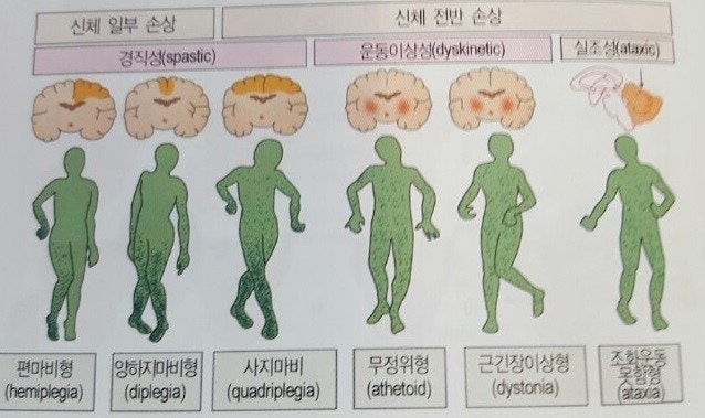 뇌성마비cerebral Palsy원인 및 증상 And 재활치료 네이버 블로그