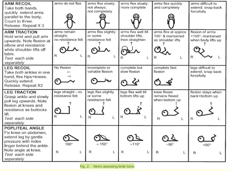 신생아의 신경학적 평가_Dubowitz neurological exam : 네이버 블로그