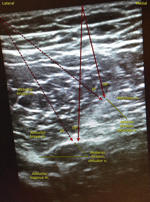 obturator nerve block 폐쇄신경 차단술, 초음파 유도하 신경차단술 방법과 팁 : 네이버 블로그